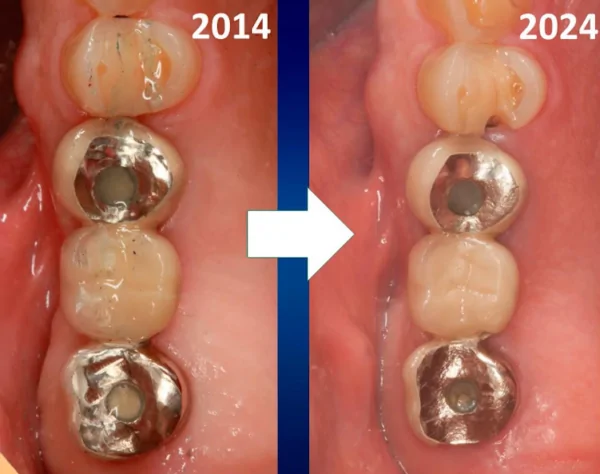 Screw Retained Vs Cemented Restorations Which Is Better