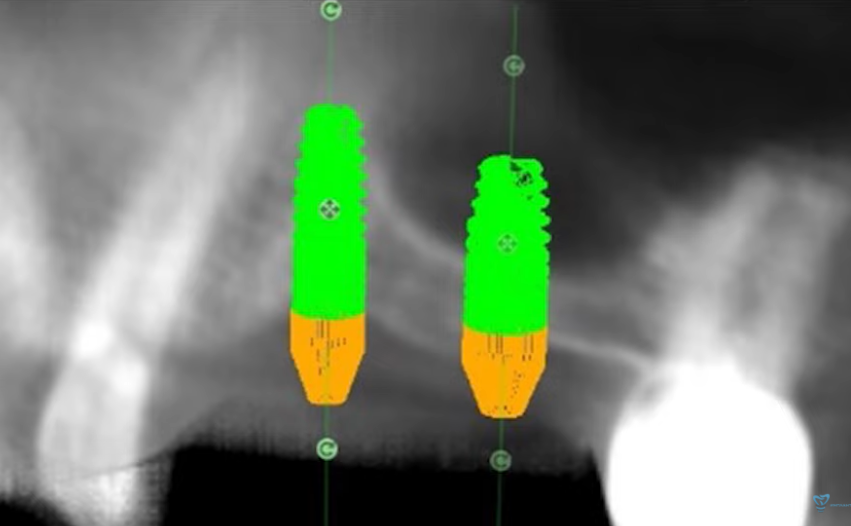 Top Dental Implant Research: Meta-Analyses of 2024
