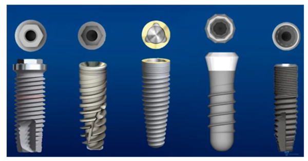 Differences Between Implants. How They Differ From Each Other When It ...
