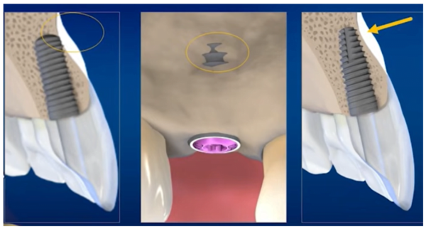 Differences Between Implants. How They Differ From Each Other When It ...