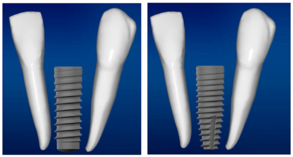 Differences Between Implants. How They Differ From Each Other When It ...