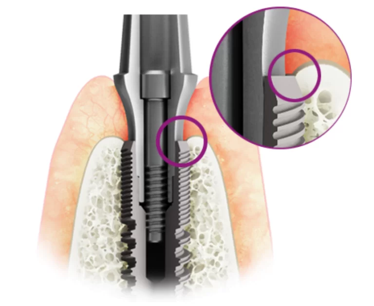 Comparison Of Implant/Abutment Connection Types