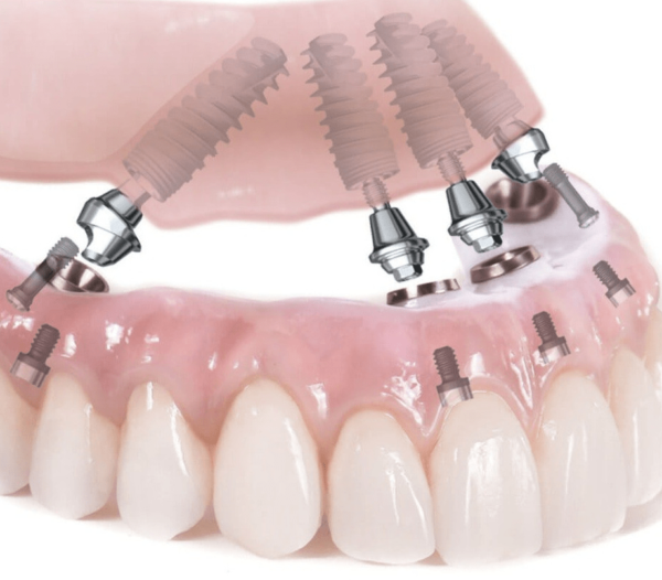 Angled Multi-Unit Abutments - Uniqa Dental