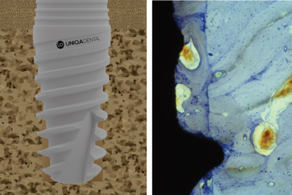 Description Of The Dental Implant Procedure