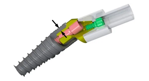 Angled Multi-Unit Abutments - Uniqa Dental