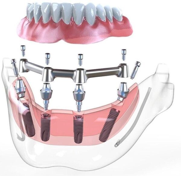 Angled Multi-Unit Abutments - Uniqa Dental