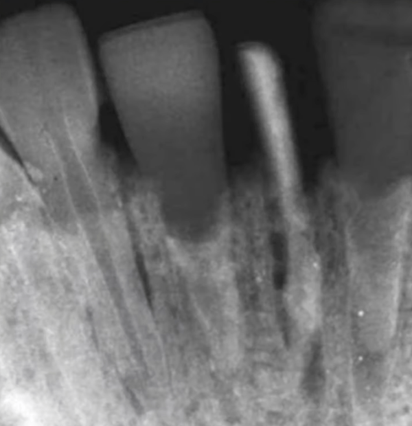 History Of Implantology: Dental Prosthetics Through The Ages - Part I