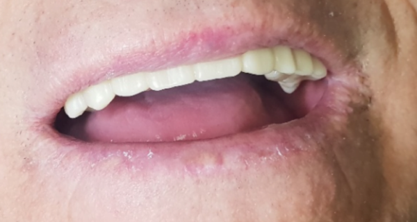 How To Choose The Right Multi-unit Abutments