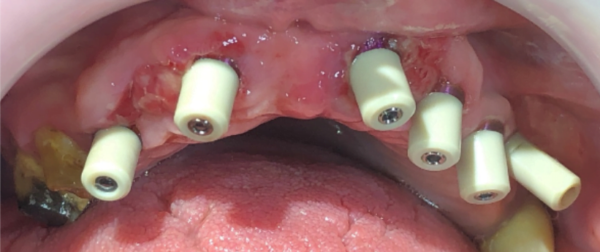 How To Choose The Right Multi-unit Abutments
