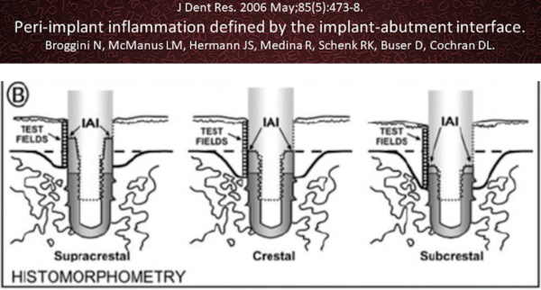 Soft Tissue Implant Integration (Part 3)