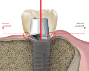 How To Select Abutment For Implant: A Comprehensive Guide