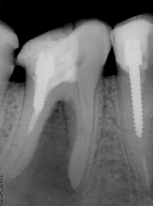 Treat Or Remove A Tooth. Part 1 (a Guide For Doctors)
