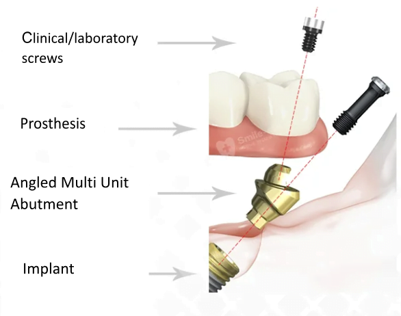 Multi-Unit Dental Abutments - Uniqa Dental
