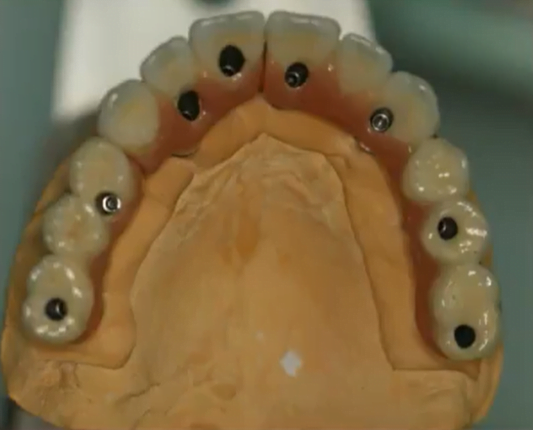 Multi-Unit Dental Abutments - Uniqa Dental