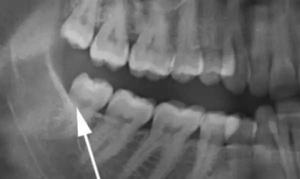 Wisdom Tooth Extraction: Understanding The Healing Process