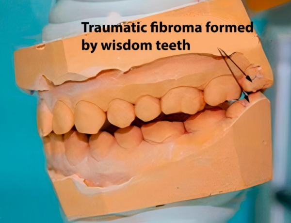 Wisdom Tooth Extraction: Understanding The Healing Process