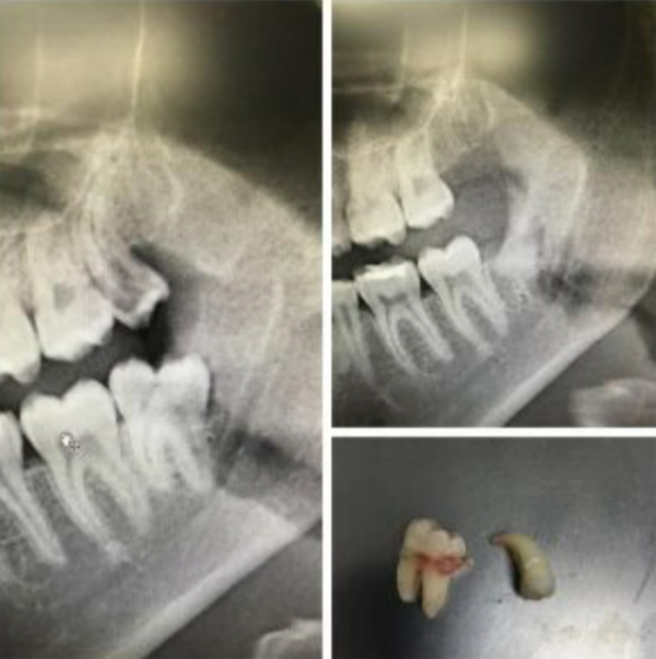 Wisdom Tooth Extraction: Understanding The Healing Process