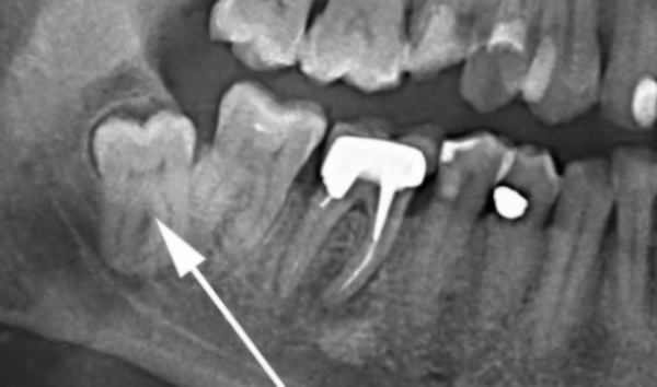 Wisdom Tooth Extraction: Understanding The Healing Process