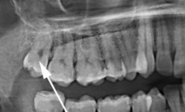 Wisdom Tooth Extraction: Understanding The Healing Process