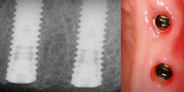 Subcrestal Implant Placement: Improving Soft Tissue Integration