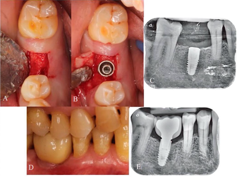 Subcrestal Implant Placement: Improving Soft Tissue Integration
