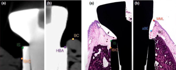 Subcrestal Implant Placement: Improving Soft Tissue Integration