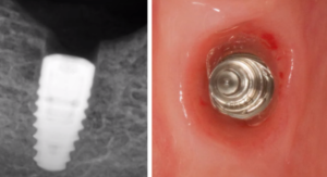 Subcrestal Implant Placement: Improving Soft Tissue Integration