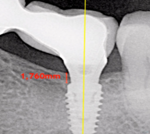 Subcrestal Implant Placement: Improving Soft Tissue Integration