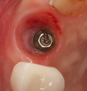 Subcrestal Implant Placement: Improving Soft Tissue Integration