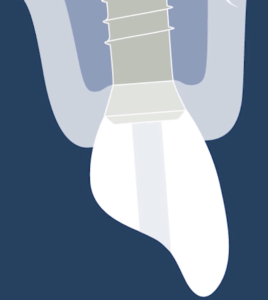 Subcrestal Implant Placement: Improving Soft Tissue Integration