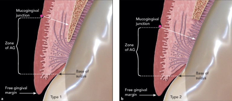 Attached Keratinized Gingiva: Problems & Solutions