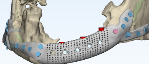Maxillofacial Surgery Technologies: 3D Printing And Robotics