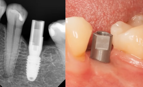 Screw Or Cement Fixation? A Guide For Dentists