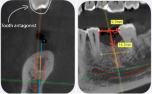 An Introduction To Dental Implant Surgery Protocols And Best Practices