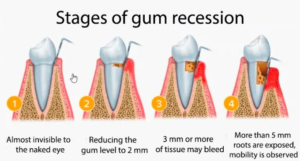 How To Correct Gingival Recession: Comprehensive Guide