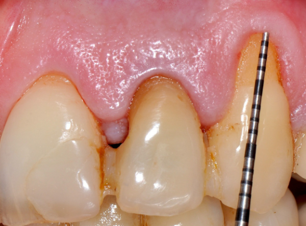 How To Correct Gingival Recession: Comprehensive Guide