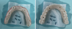 Full-Arch Dental Implants: Protocols And Advanced Techniques