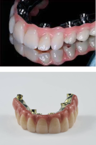 Full-Arch Dental Implants: Protocols And Advanced Techniques