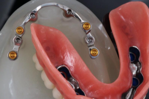 Full-Arch Dental Implants: Protocols And Advanced Techniques