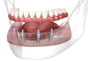 Full-Arch Dental Implants: Protocols And Advanced Techniques