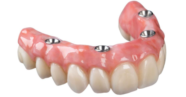 Full-Arch Dental Implants: Protocols And Advanced Techniques