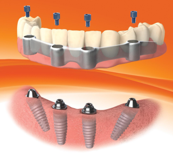 Full-Arch Dental Implants: Protocols And Advanced Techniques
