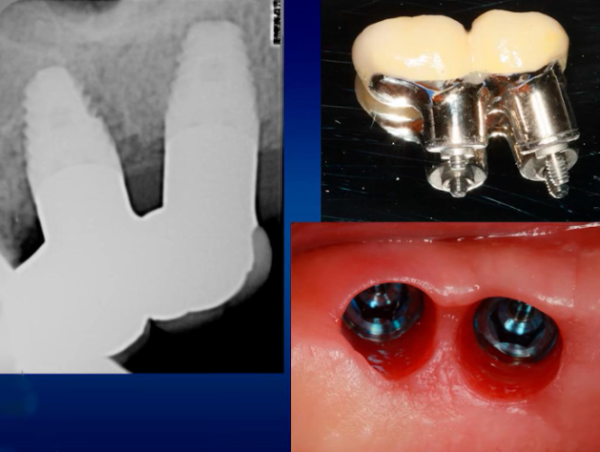 Screw-retained Vs. Cemented Restorations: Which Is Better?