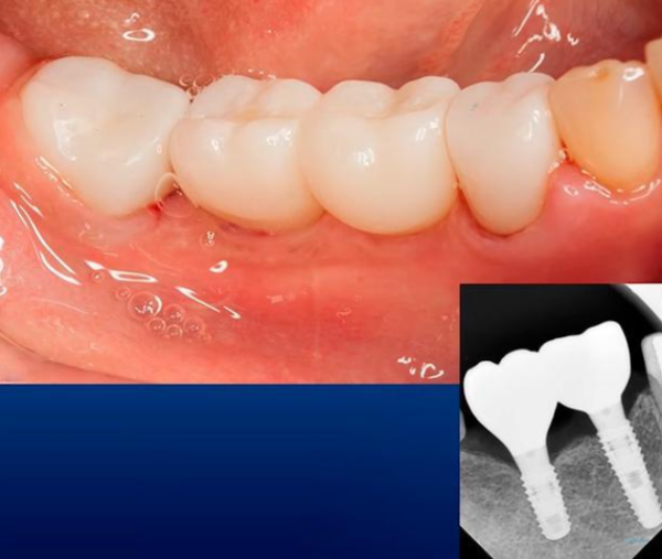 Screw-retained Vs. Cemented Restorations: Which Is Better?