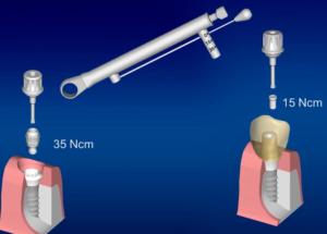 Screw-retained Vs. Cemented Restorations: Which Is Better?