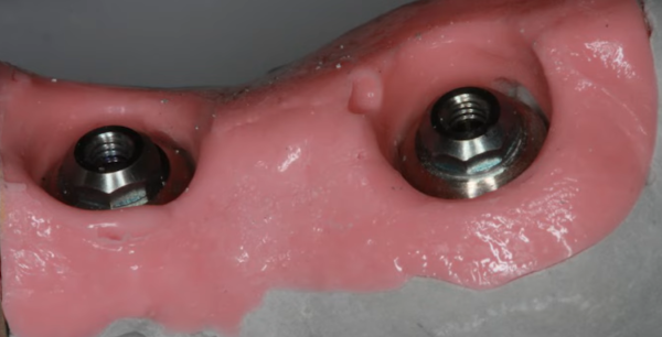 Screw-retained Vs. Cemented Restorations: Which Is Better?