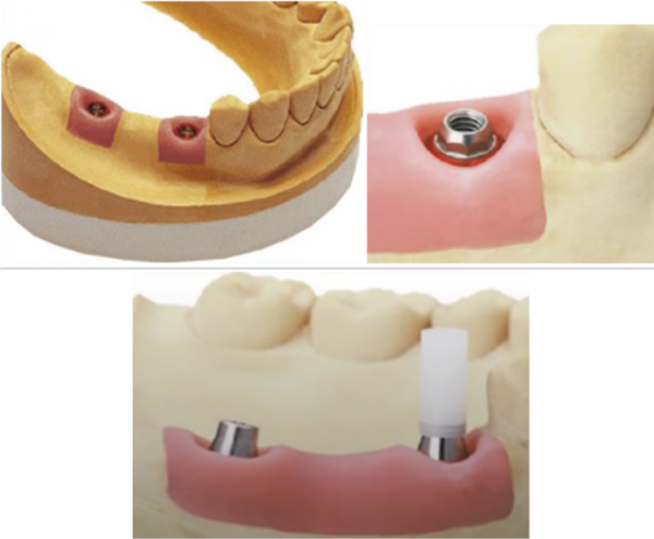 Screw-retained Vs. Cemented Restorations: Which Is Better?