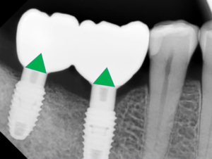 Screw-retained Vs. Cemented Restorations: Which Is Better?