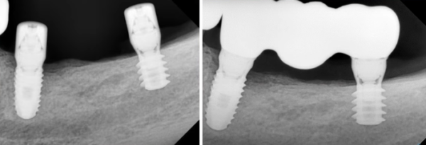 Screw-retained Vs. Cemented Restorations: Which Is Better?