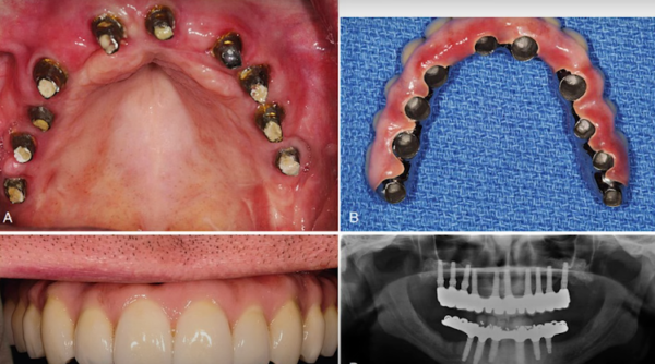 Screw-retained Vs. Cemented Restorations: Which Is Better?